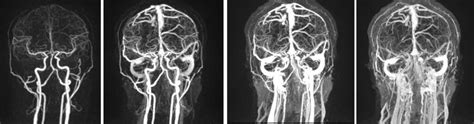 Cavernous Sinus Mri Mri Cavernous Sinus Protocol And Planning