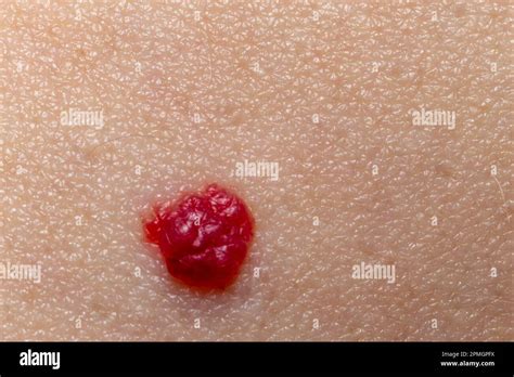 Red Mole On Face