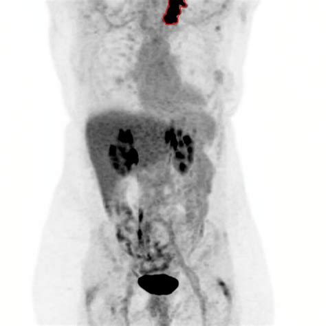 Salvage Radiotherapy Gross Tumor Volume Red For A Patient With Download Scientific Diagram