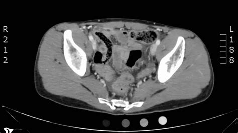 Appendicitis Annotated Ct Jetem 2017 Youtube