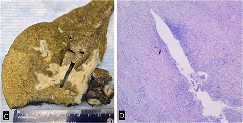 Igg4 Related Sclerosing Cholangitis With Associated Inflammatory Pseudotumor “strikes” Again As
