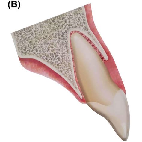 Elian Et Al ⁶⁸ Classification Of Alveolar Sockets According To The