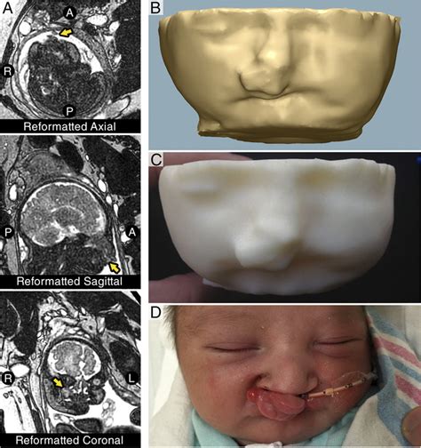 Segmentation Modeling And 3d Printing Of Fetal Mri A Download Scientific Diagram