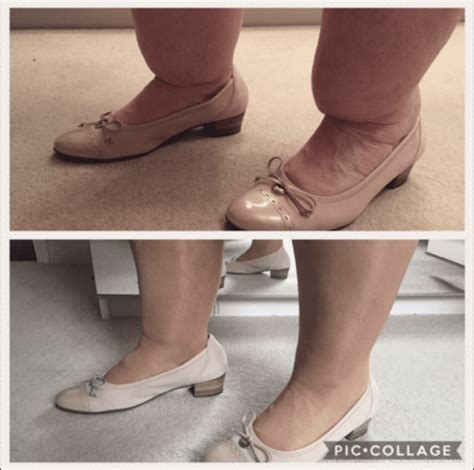 Ankle Cankle Contouring The Karri Clinic
