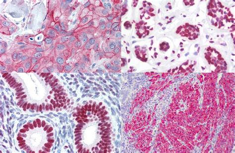 Lsbio Offers Breast Cancer Ihc Marker Antibodies
