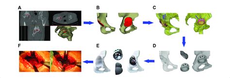 Clinical Application Of The Iap A Acetabular Cup Placement In True Download Scientific