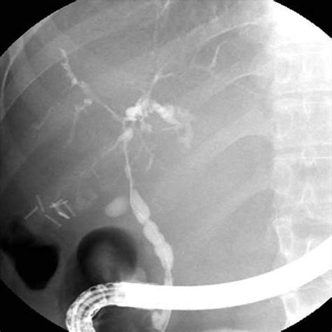Abdomen And Retroperitoneum 1 2 Gallbladder And Bile Ducts Case 1 2 18 Bile Duct