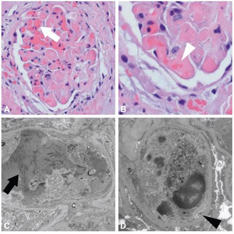 Glomerular Disease Of Complement Dysregulation C3 Glomerulopathy Atypical Hemolytic Uremic