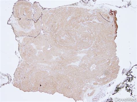Leiomyoma Of Scrotum