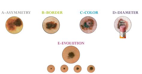 Melanoma Symptoms And Detection