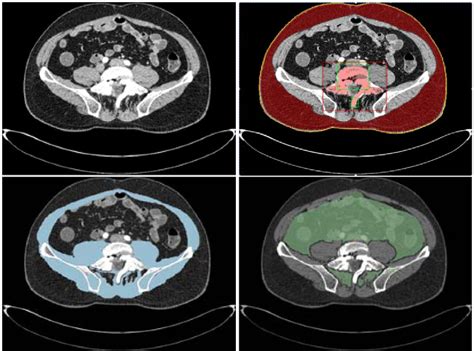 Mesenteric Vasculature Guided Small Bowel Segmentation On 3 D Ct
