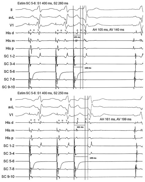 Curva de estimulación anterógrada S ms S ms Se evidenció Download Scientific