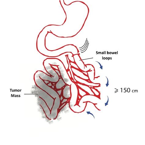 Preparation Of The Colon From The Middle Part Of The Transverse Colon Download Scientific
