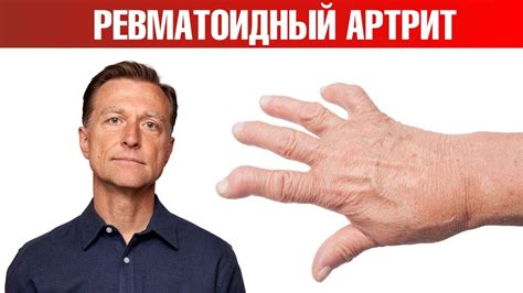 13 натуральных средств от ревматоидного артрита👌 Youtube