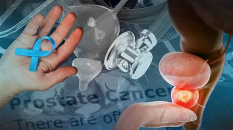 Prostate Cancer New Treatment Offers Hope To Ph Patients Inquirer News