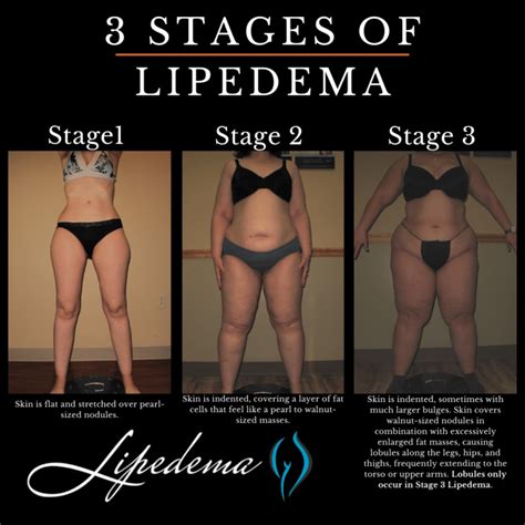 Interstitial Fluid What Is It And How Does It Impact Lipedema And Lymphedema St Louis Laser