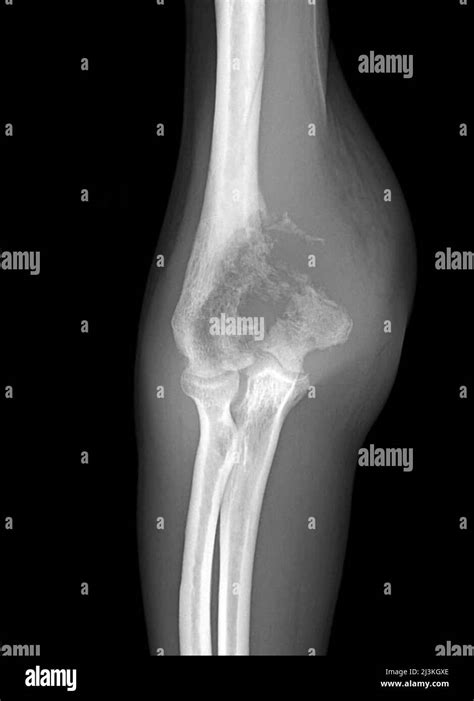 Osteosarcoma X Ray