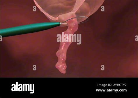 Surgical Anesthesia History Stock Videos And Footage Hd And 4k Video