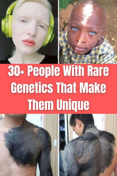 People With Rare Genetics That Make Them Unique Artofit