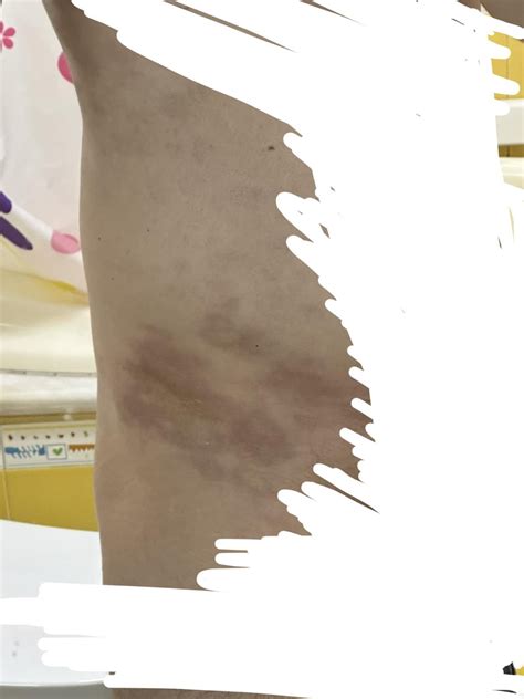 Diagnosed With Plaque Morphea R Scleroderma