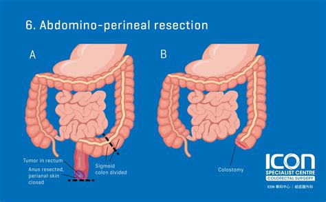 Urinary Incontinence After Colon Resection At Sandra Madrigal Blog