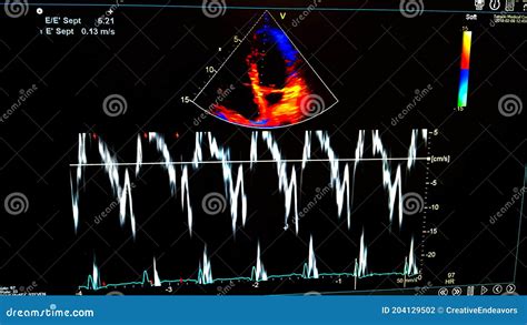 Echocardiogram Or Echo Exam For Heart Disease Diagnosis Outline Diagram Cartoon Vector