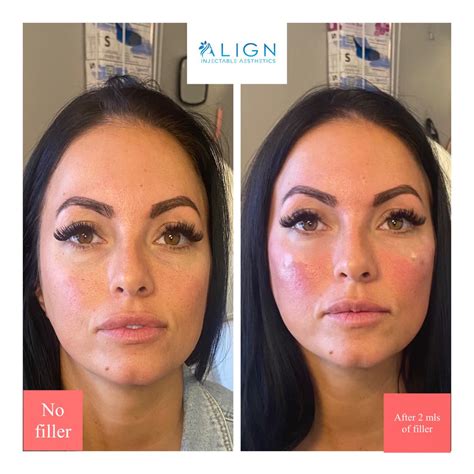 Facial Fillers Facial Fillers Cheek Fillers Face Fillers