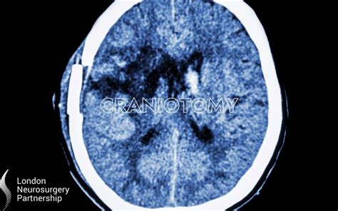 Pars Defect London Neurosurgery Spine And Neurosurgery