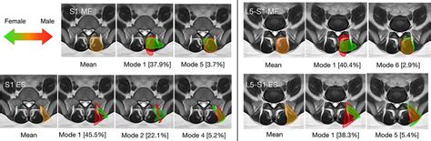 Modes Of The Multifidus Mf And Erector Spinae Es Shape Associated