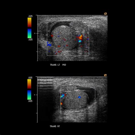 Pediatric Epididimo Orchitis Pediatric Radiology Reference Article