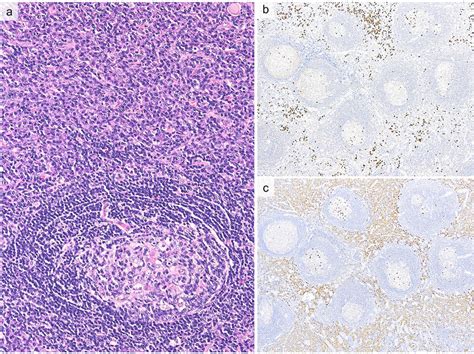 Lymph Node Histology In A Patient With A Plasma Cell Neoplasm Download Scientific Diagram