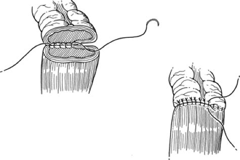 Right And Left Colon Resections Basicmedical Key