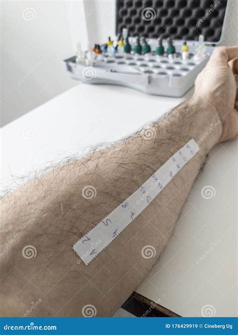 Allergy Scratch Test Stock Image Image Of Immunology 176429919
