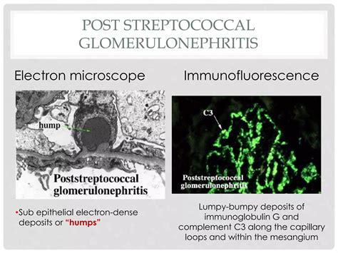 Glomerular Diseases Pptx