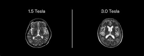Mri 30 Tesla ดีกว่า 15 อย่างไร โรงพยาบาลธนบุรี