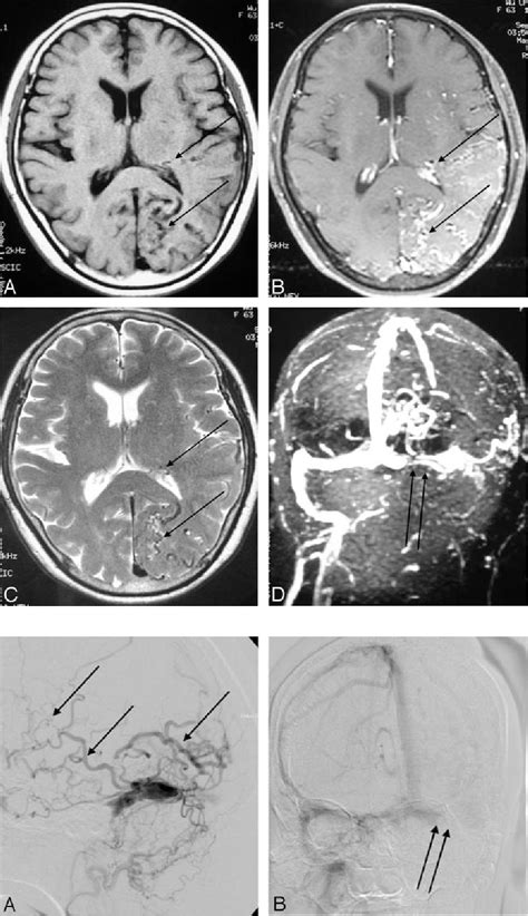 Figure 1 From Unilateral Subcortical Calcification A Manifestation Of Dural Arteriovenous