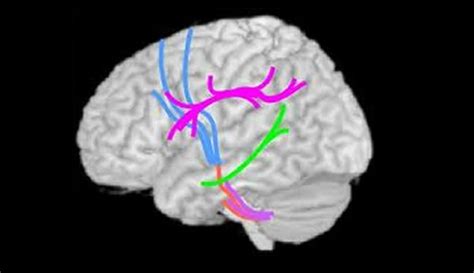 Brain Scans Detect Early Signs Of Autism Neuroscience News