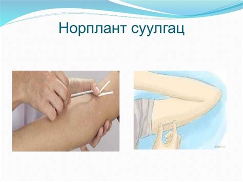 Гоодаль эмнэлэг Жирэмсэлтээс хамгаалах Арьсан доорх суулгац буюу имплантант буюу норплант