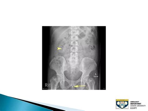 Bladder And Urethral Calculi Pptx