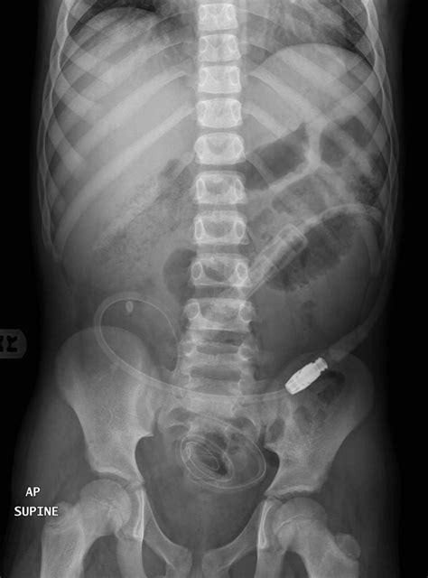 Appendicitis With Phlegmon Buyxraysonline
