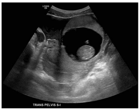 Second Trimester Interstitial Ectopic Pregnancy V1
