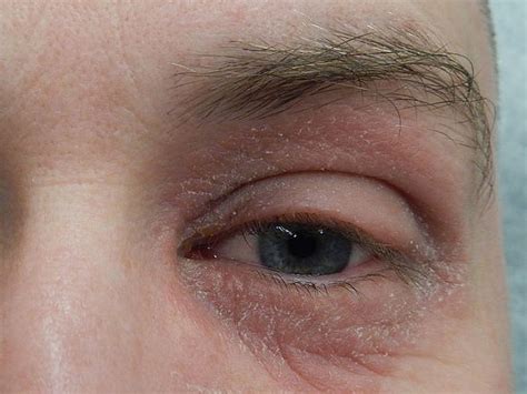 Periorbital Eczema