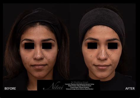 Cheek Enhancement Before After Images Laser Skin Treatment Clinic Melbourne Nitai Medical