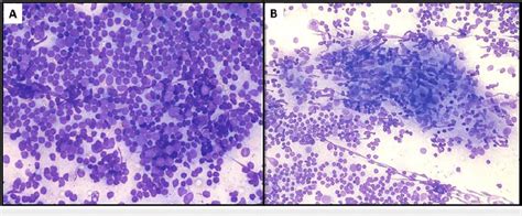 A Highly Cellular Smears Showing A Polymorphous Population Of