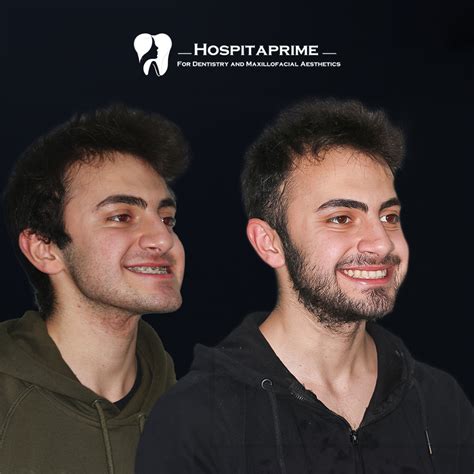 Before After Hospitaprime