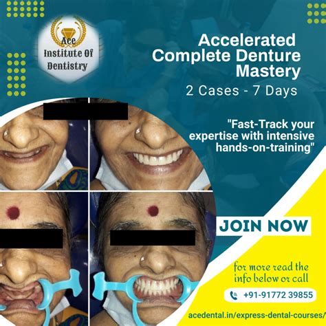 Complete Denture 2 Cases 1 Week Ace Dental