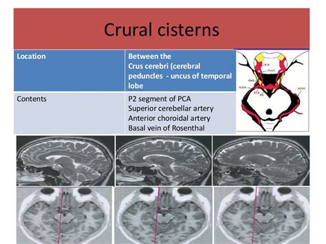 Cisterns Of Brain And Its Contents Along With Its Classification And