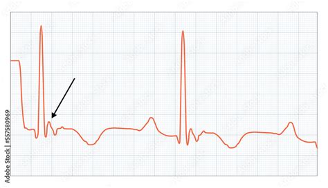 Epsilon Wave Ecg Posterior Myocardial Ventricular Infiltrative Disease Test Chart Stock