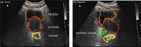 A Axial And B Sagittal Ultrasound Image Acquired Using A Commercial