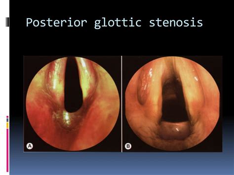 Ppt Laryngeal Complications Of Endotracheal Intubation Powerpoint